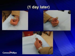 HF_Acid_Burn_Victim.ppt