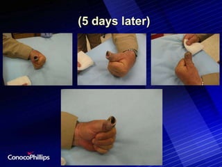 HF_Acid_Burn_Victim.ppt