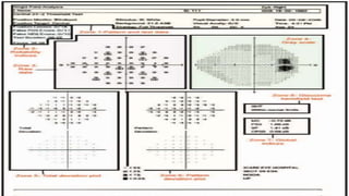 Humphreys visual field analysis powerpoint.pptx