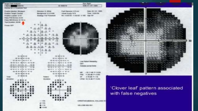Humphreys visual field analysis powerpoint.pptx