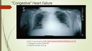 HF clinical presentation slides | PPTX