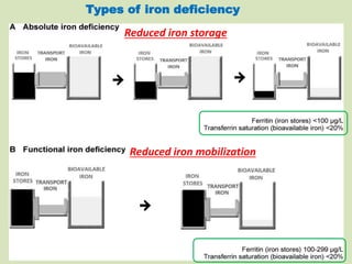 Iron Deficiency : An Overlooked Aspect of Heart Failure Management | PPTX