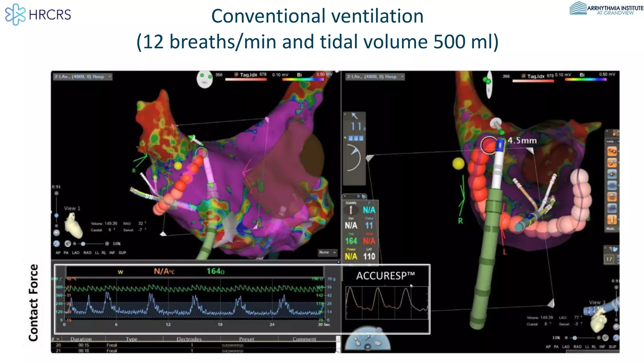 High Frequency Low Tidal Volume Ventilation during AF ablation | PPTX
