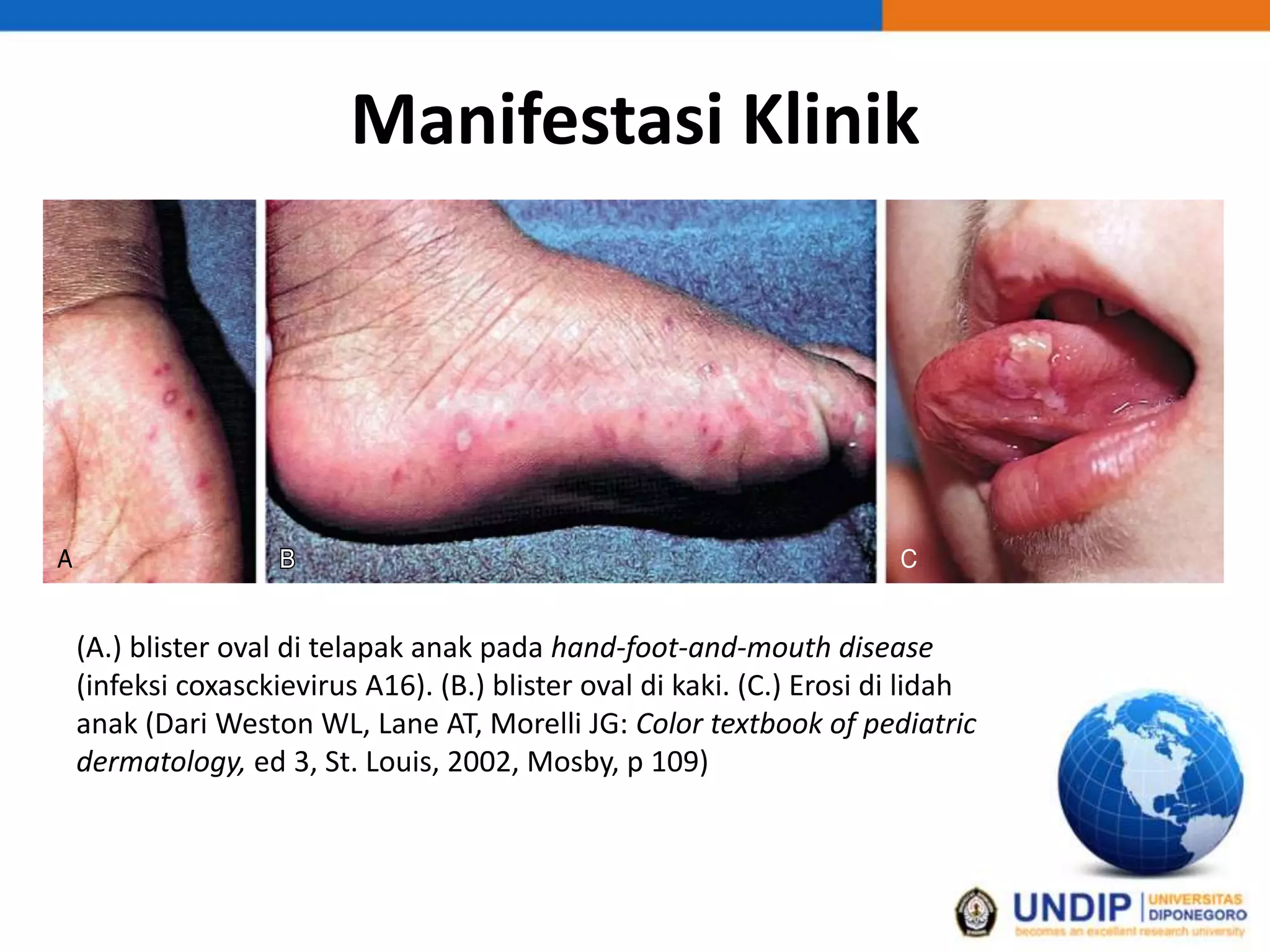 Hand foot mouth disease - flu singapur | PPTX
