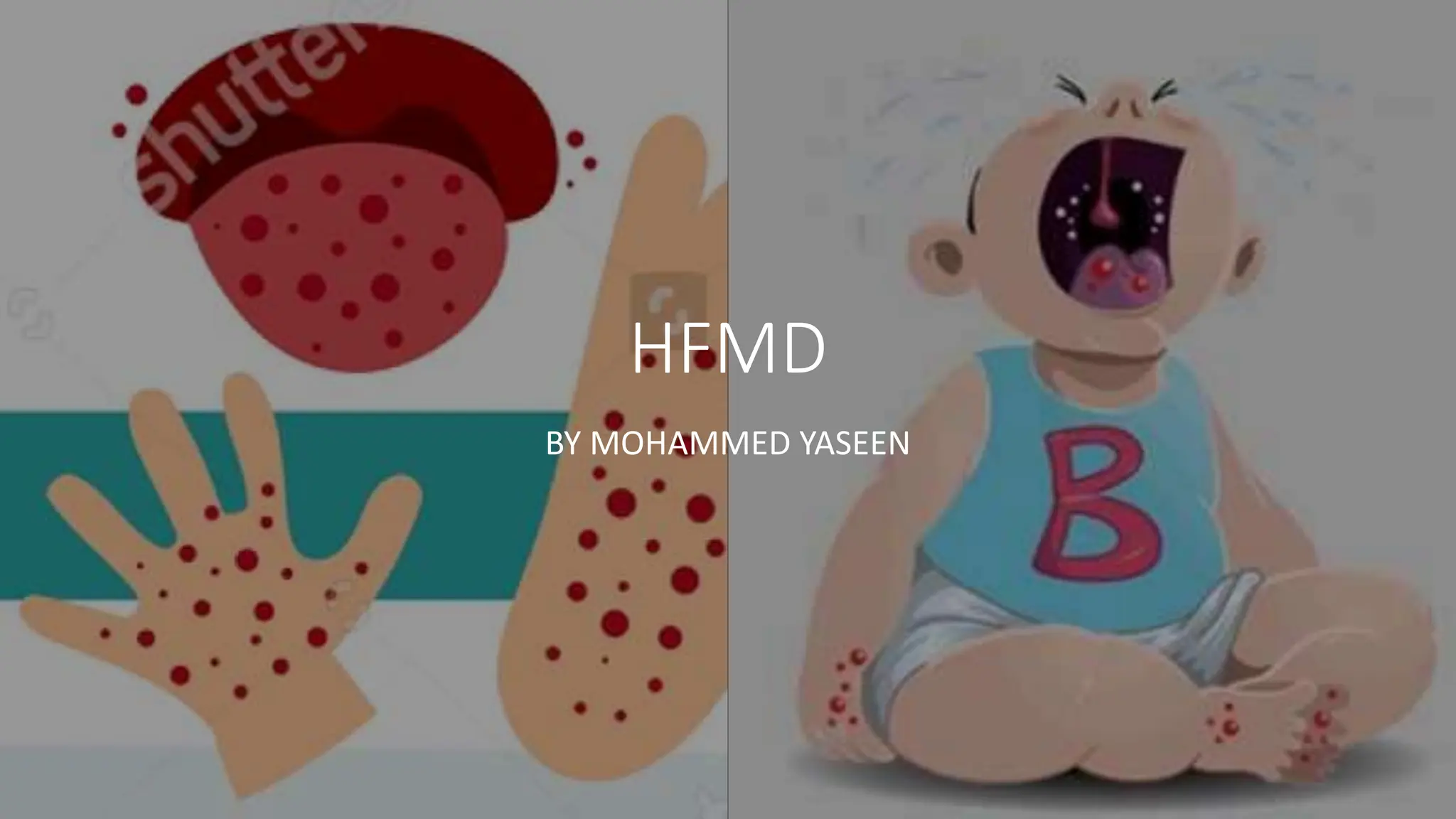 what is HFMD or hand foot mouth disease.pptx