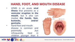 hand foot and mouth disease presentation | PPTX