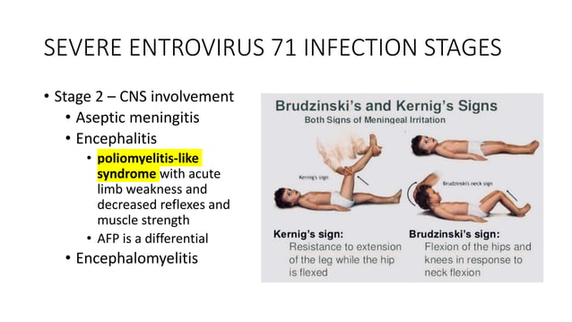 HFMD-Presentation.pptx | Infectious Diseases | Diseases and Conditions