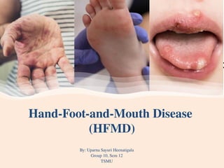 HFMD - Hand foot mouth disease, Overview | PPTX