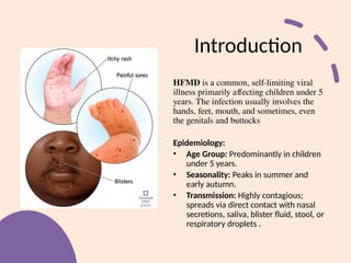HFMD - Hand foot mouth disease, Overview | PPTX