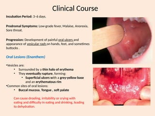HFMD - Hand foot mouth disease, Overview | PPTX