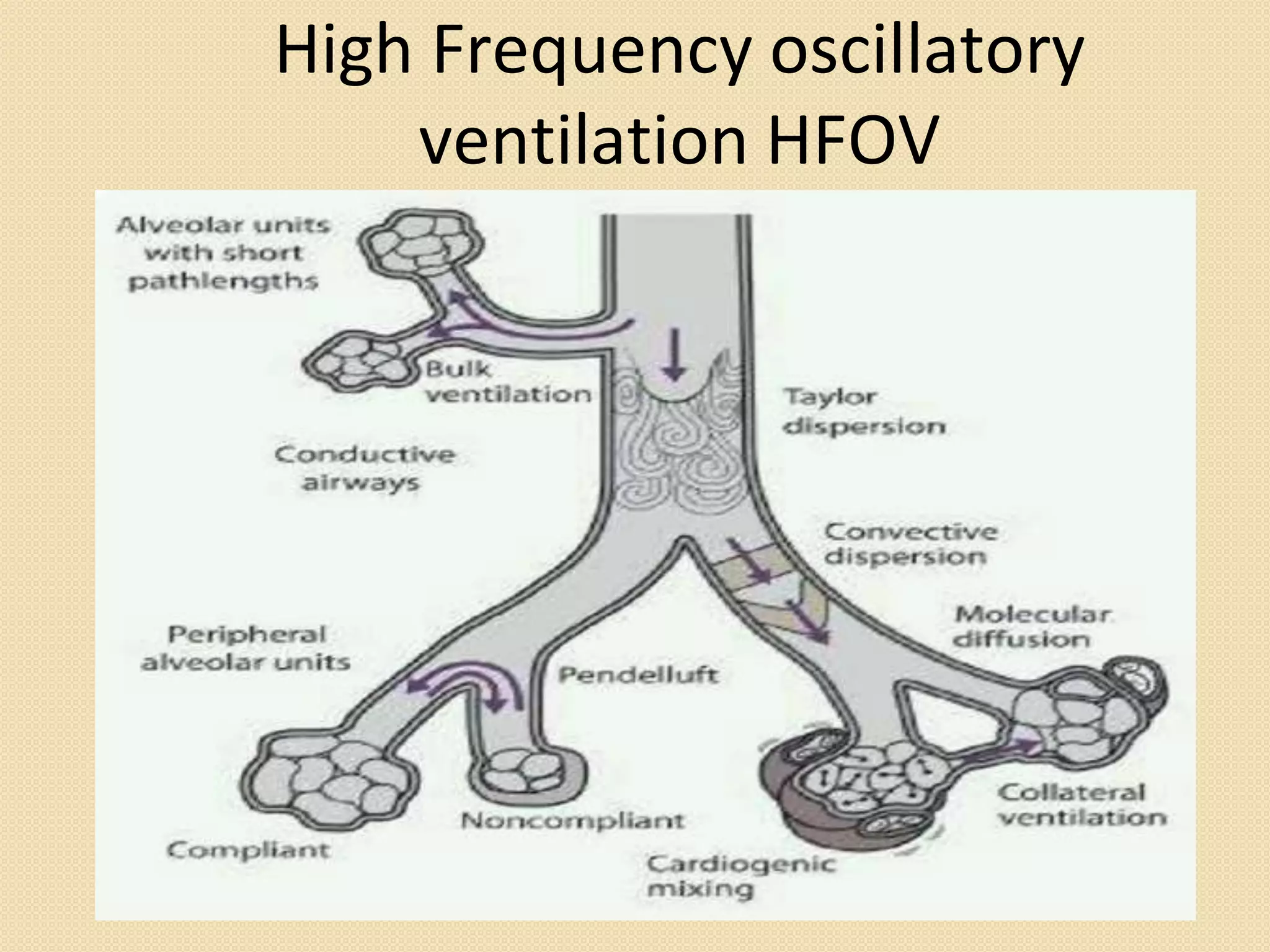 HFOV in Neonates.pptx