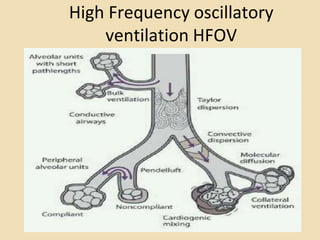 HFOV in Neonates.pptx