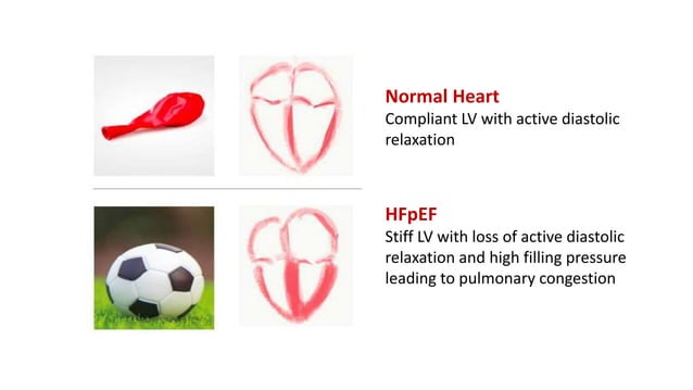 Heart Failure with Preserved Ejection Fraction(HFpEF).ptx