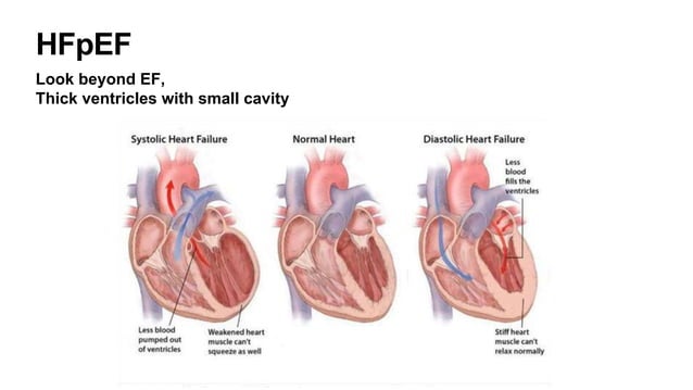 Acute Decompensated Heart failure (ADHF), Heart failure with preserved ... Acute Decompensated Heart failure (ADHF), Heart failure with preserved ...