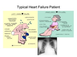 Heart Failure in Women: More than EF? | PDF