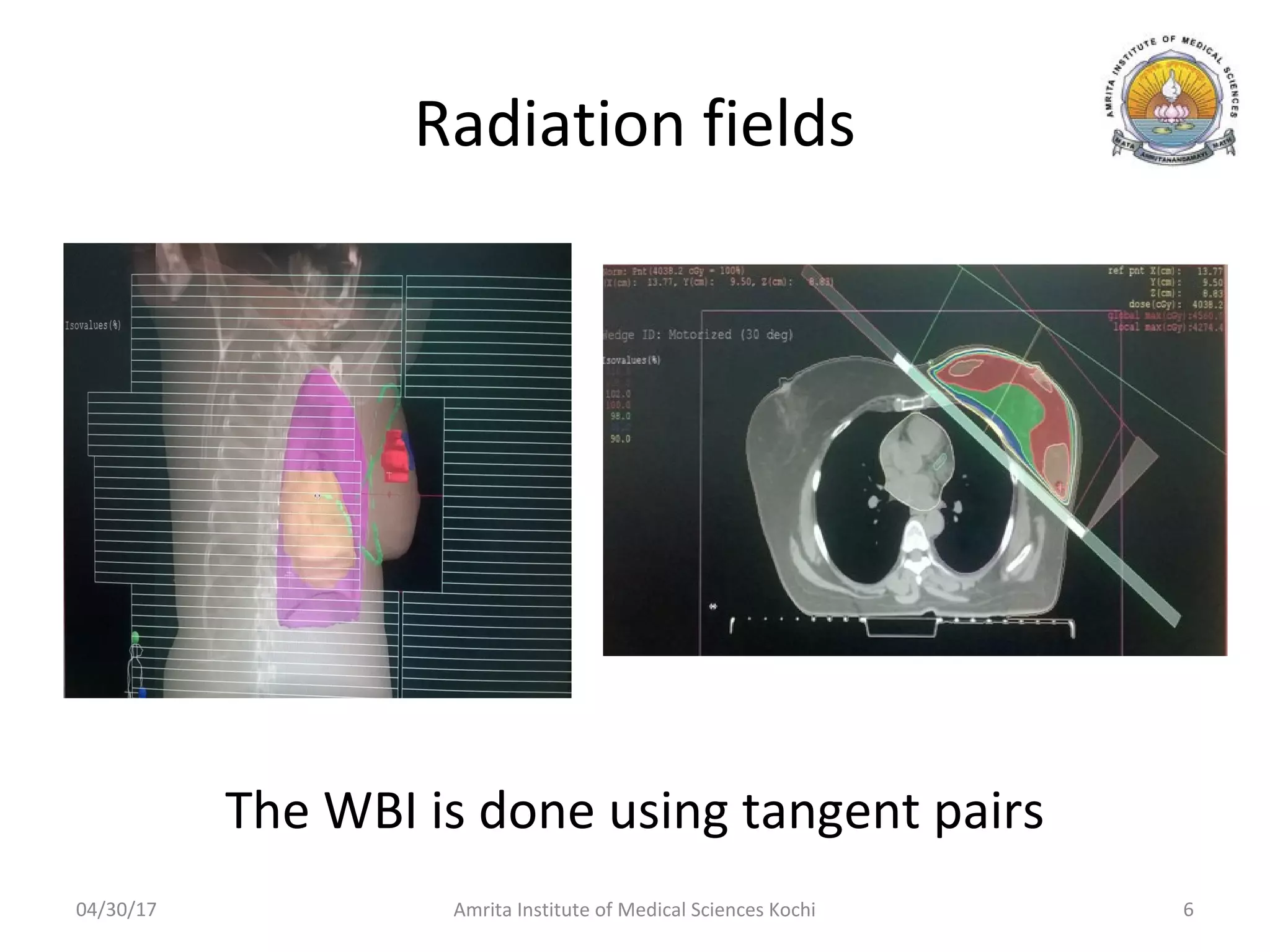 Hypofractionated Radiation Therapy in Breast Cancer | PPT