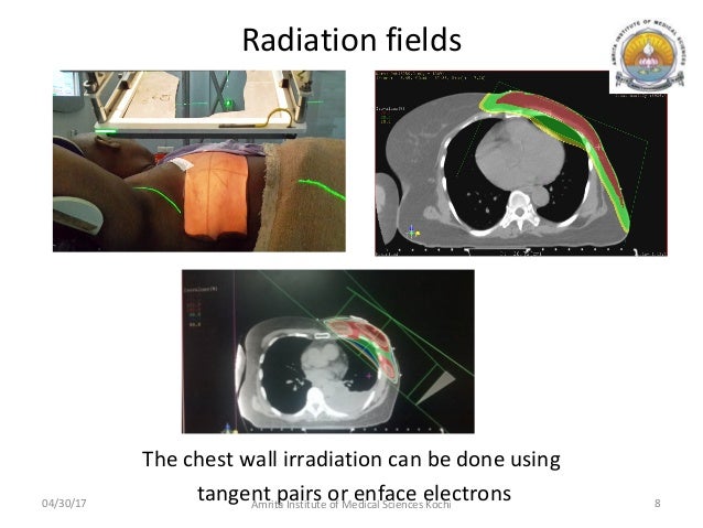 Hypofractionated Radiation Therapy in Breast Cancer