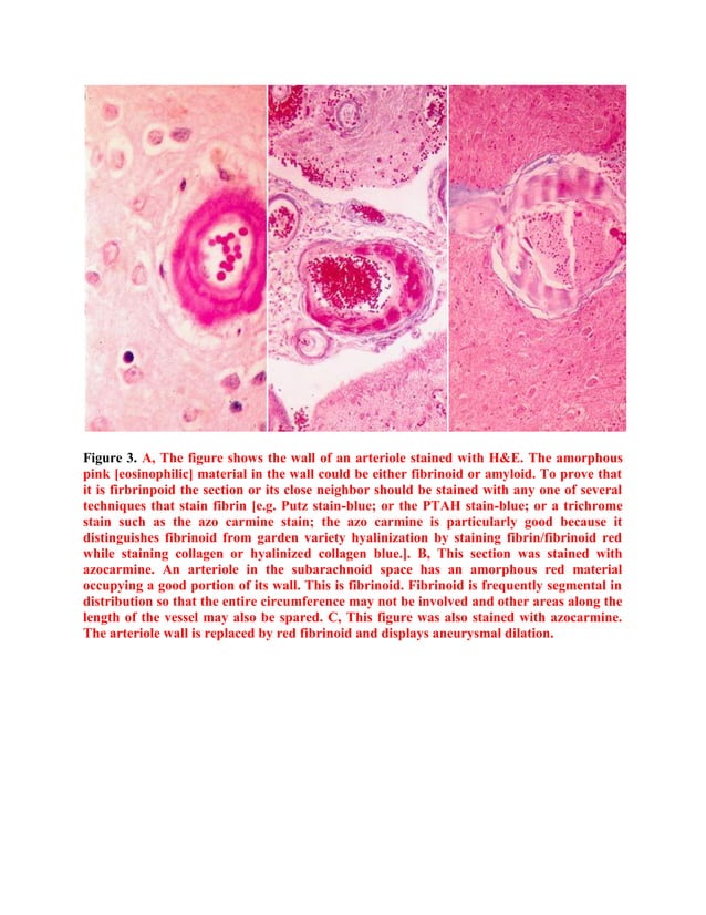 Topic of the month: Radiological pathology of microvascular cerebral ...