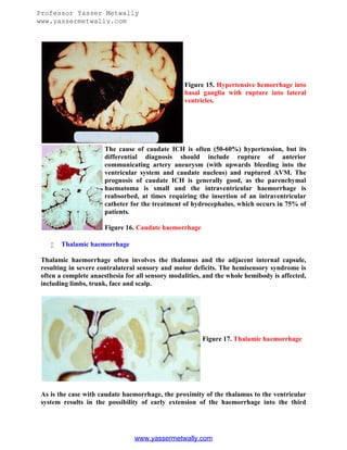 Radiological pathology of spontaneous cerebral hemorrhage | PDF