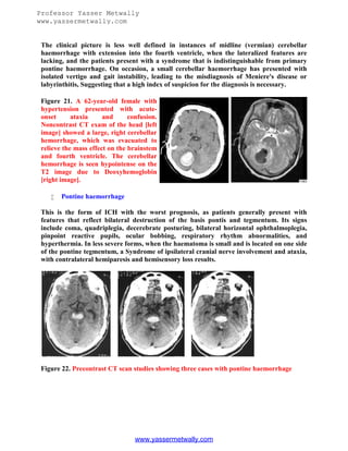 Radiological pathology of spontaneous cerebral hemorrhage | PDF