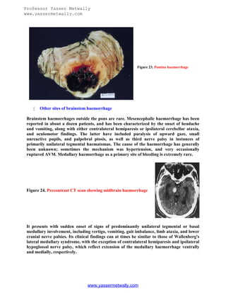 Radiological pathology of spontaneous cerebral hemorrhage | PDF