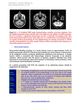 Radiological pathology of spontaneous cerebral hemorrhage | PDF