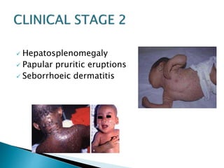 Staging and clinical manifestation of HIV | PPTX