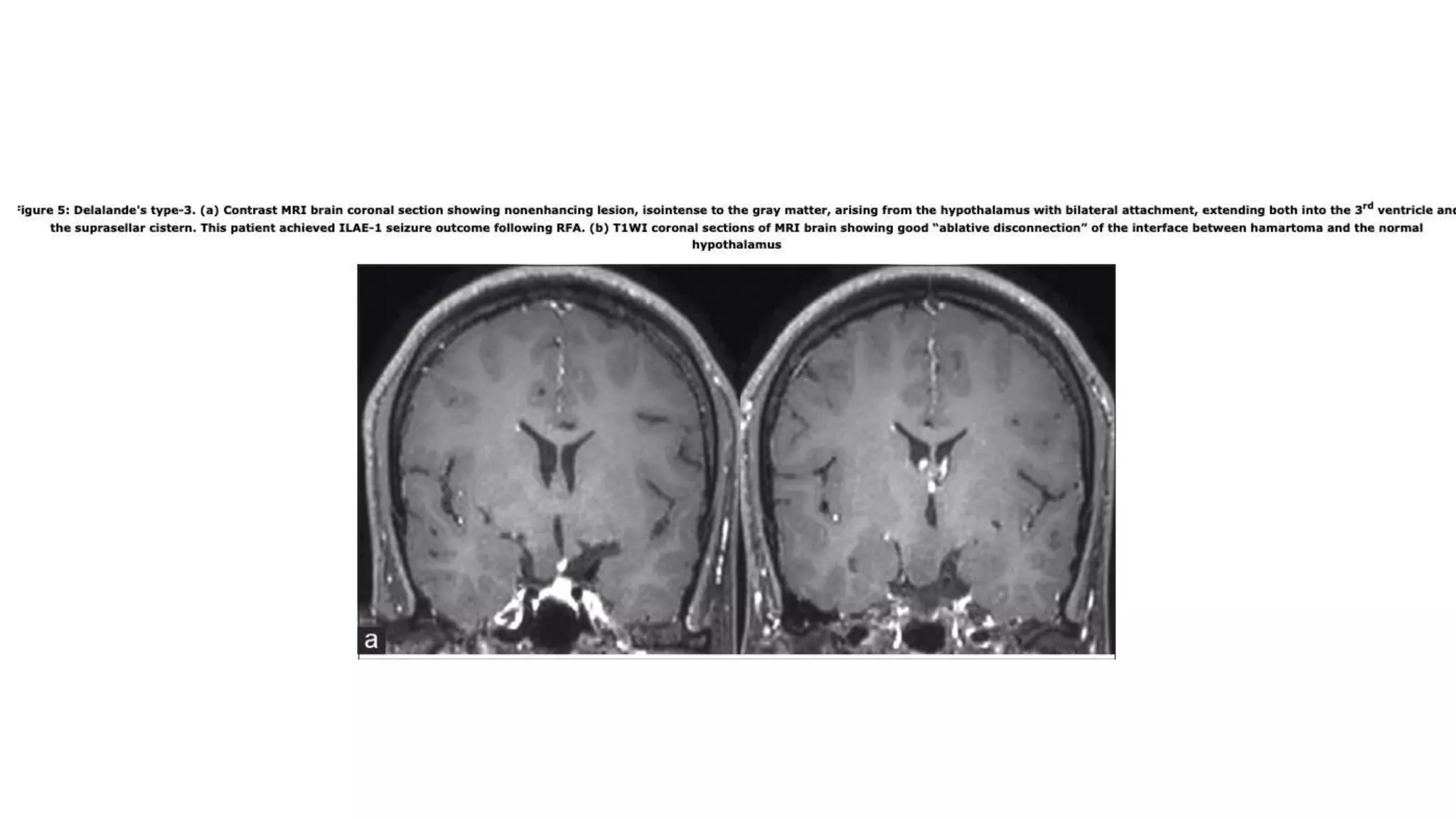 hypothalamic hamartoma | PPTX