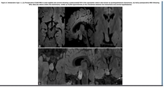 hypothalamic hamartoma | PPTX