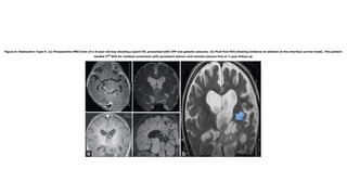 hypothalamic hamartoma | PPTX
