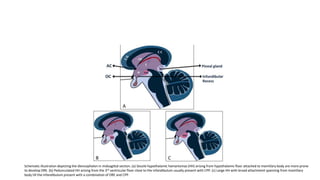 hypothalamic hamartoma | PPTX