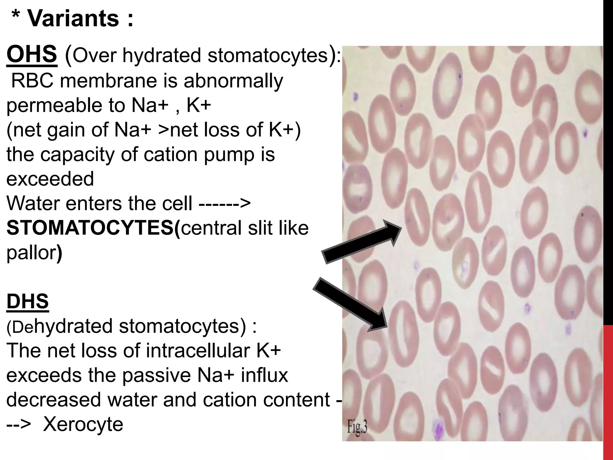 Hereditary Hemolytic Anemias | PPTX
