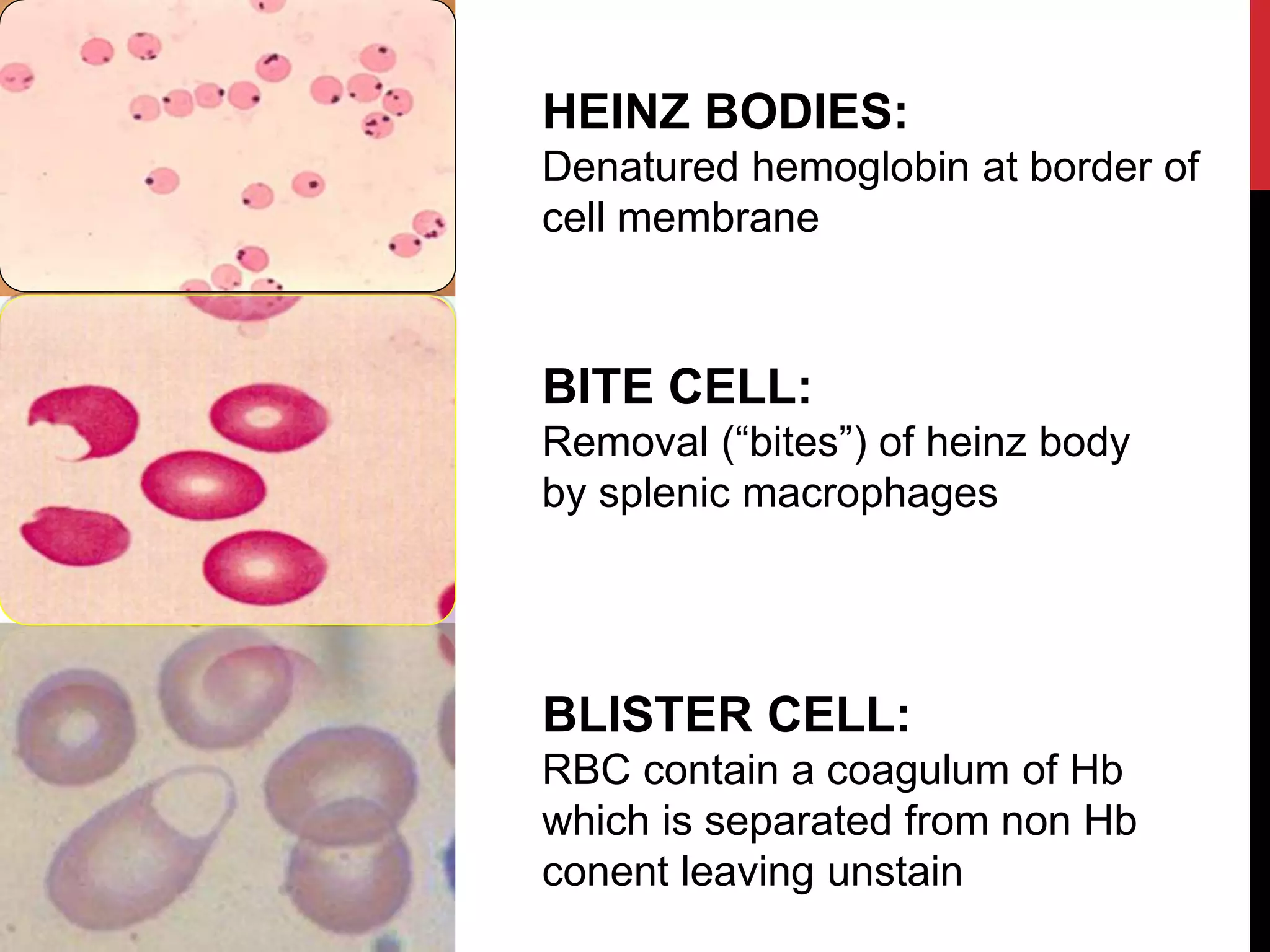 Hereditary Hemolytic Anemias | PPTX