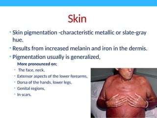 Hhemochromatosis in the liver سمنار.pptx