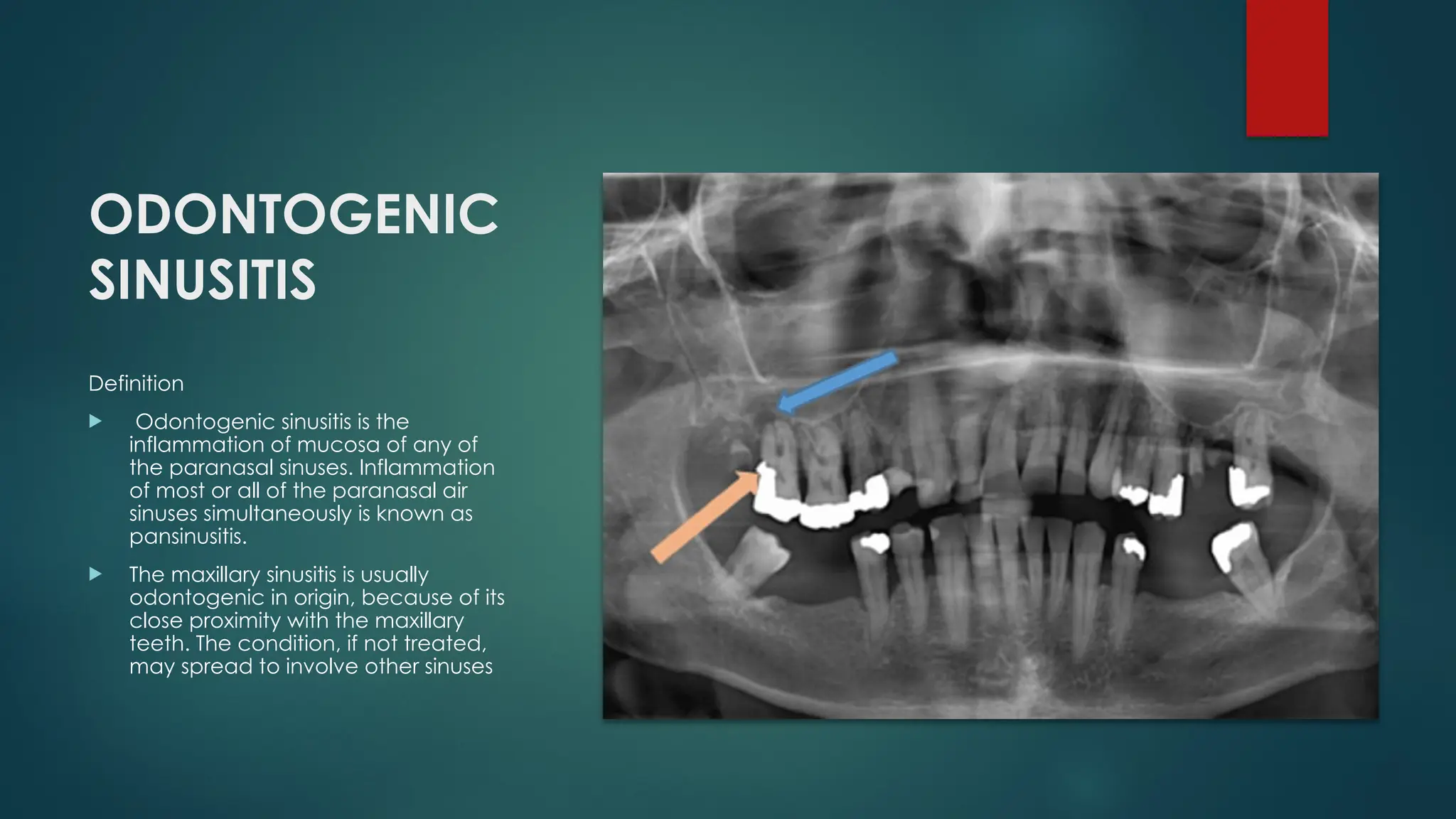 space infection of maxillary sinus chronic and acute | PPTX