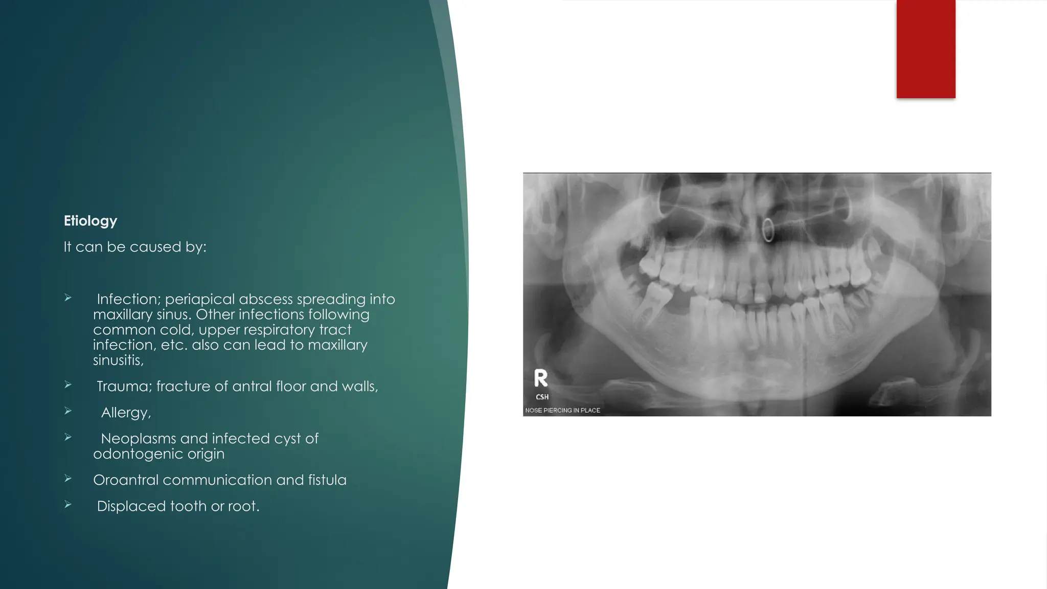 space infection of maxillary sinus chronic and acute | PPTX