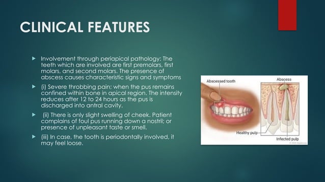 space infection of maxillary sinus chronic and acute | PPTX