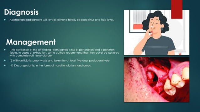 space infection of maxillary sinus chronic and acute | PPTX