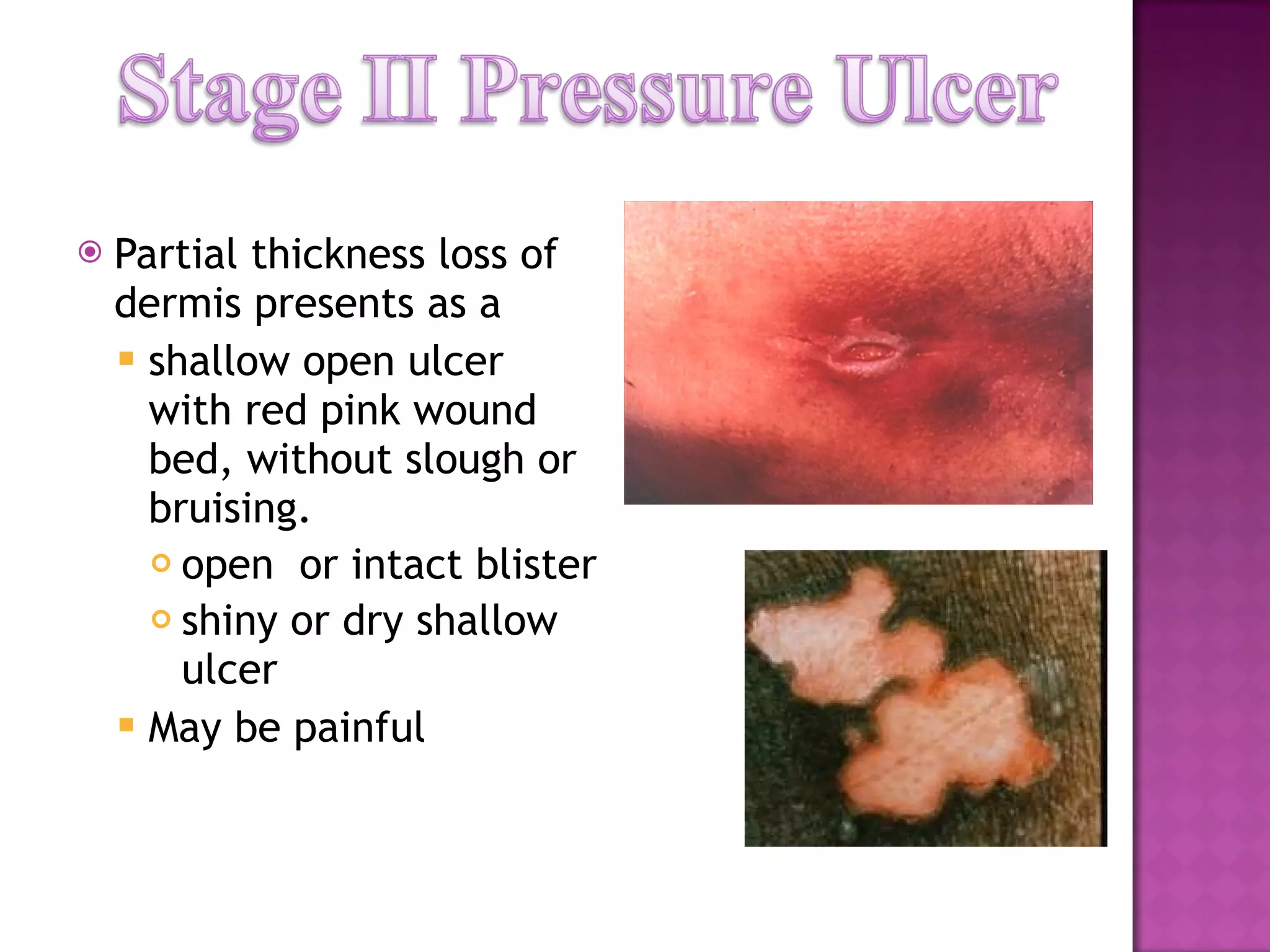 WOUND CARE | PPT