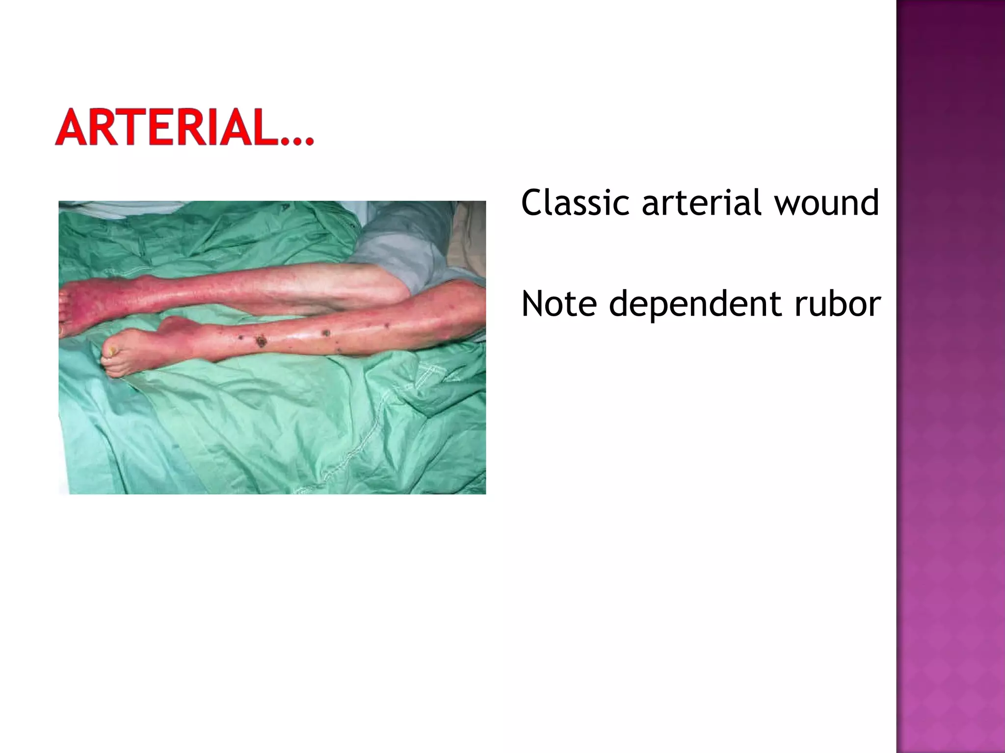 WOUND CARE | PPT