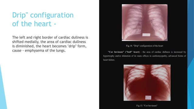 percussion of heart.pptx | Heart and Cardiovascular Diseases | Diseases ...
