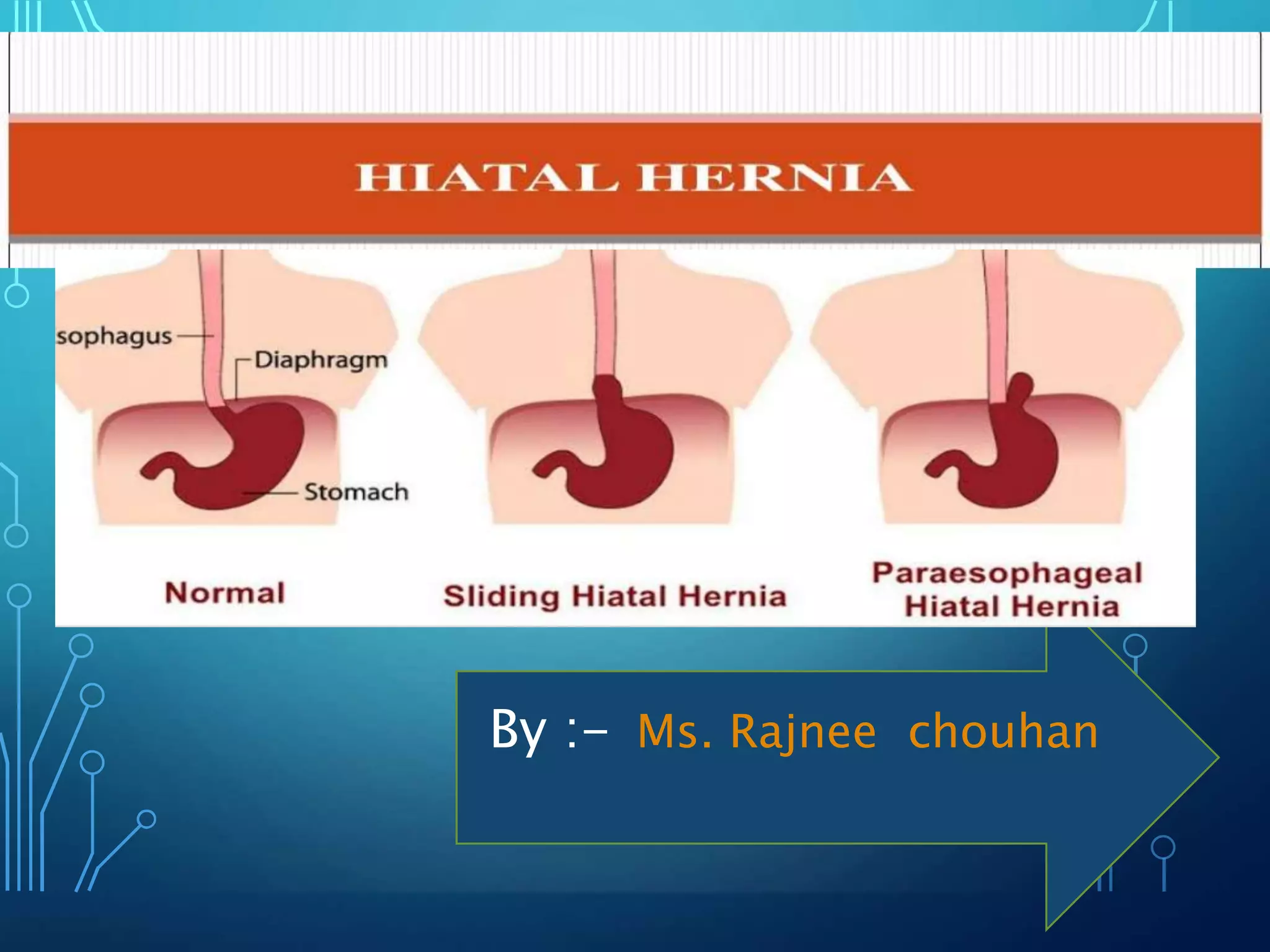 hiatal-hernia.pptx