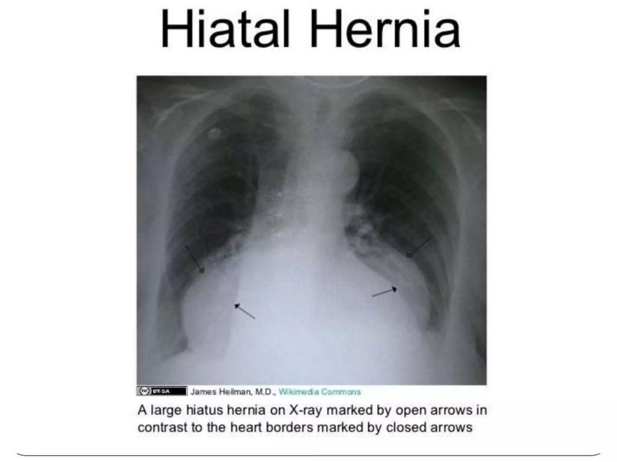 hiatal-hernia.pptx