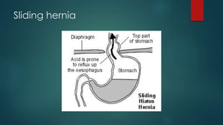 Hiatal hernia | PPT