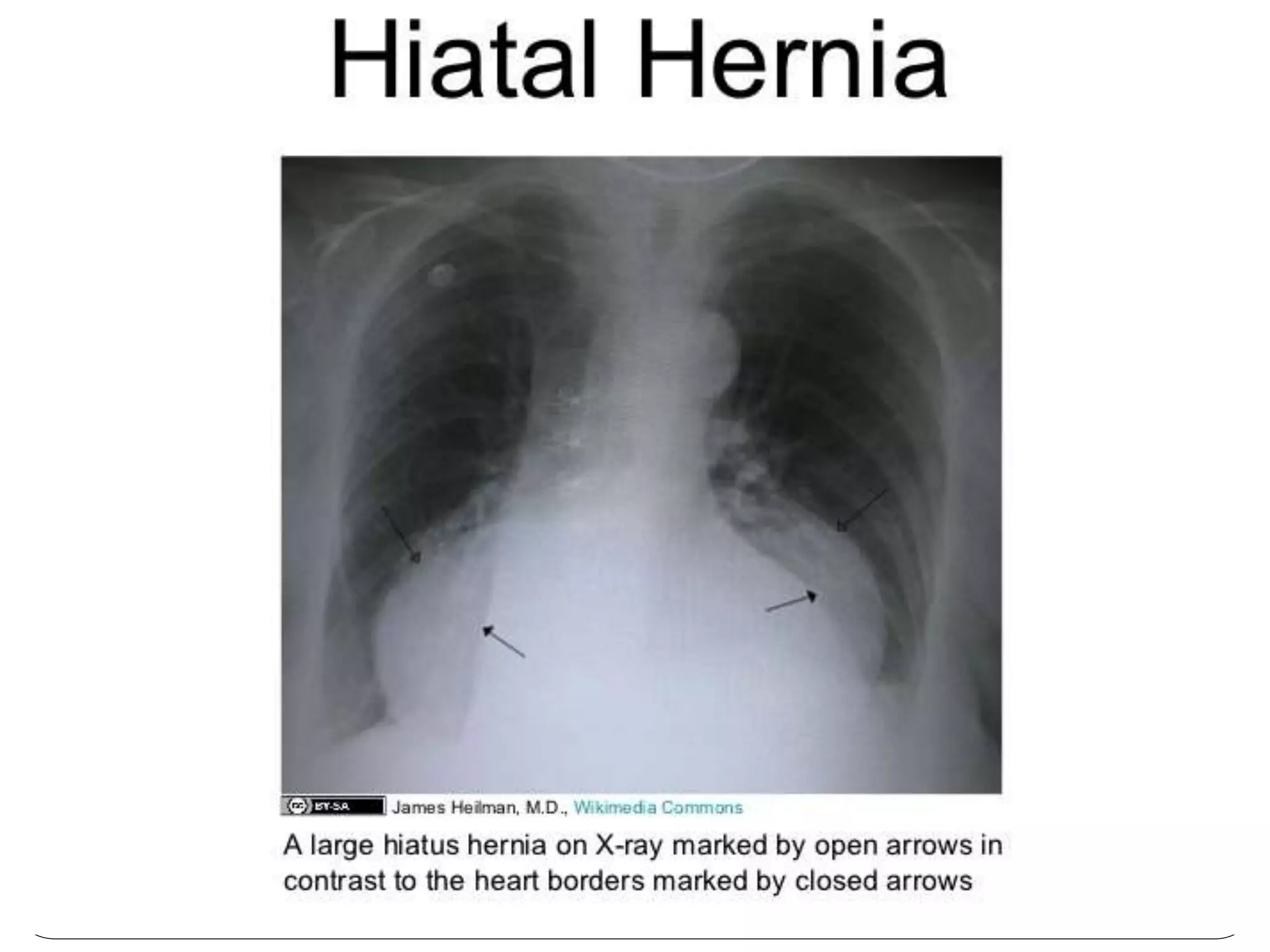 Hiatal hernia | PPTX