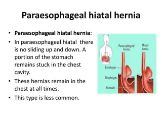 Hiatal hernia | PPTX