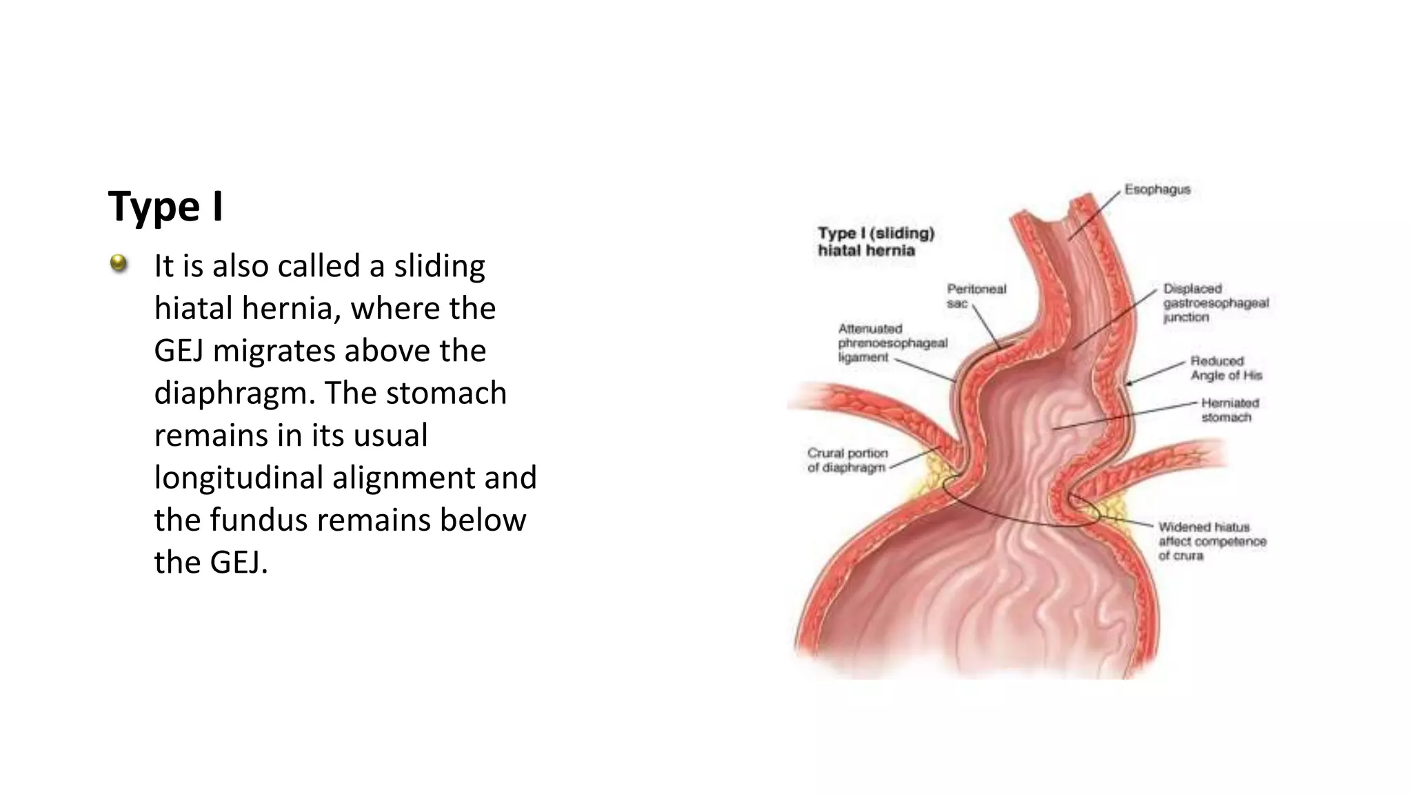 Hiatal hernia | PPTX