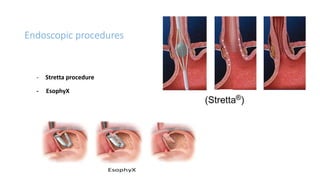 Hiatal hernia | PPTX