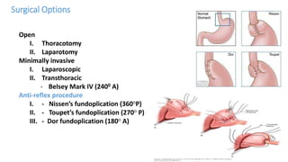 Hiatal hernia | PPTX
