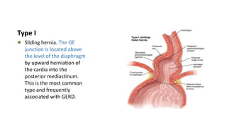 Hiatal hernia | PPTX